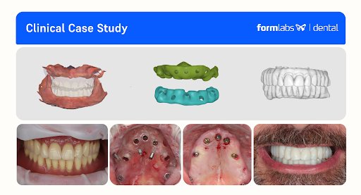 Double Digital Full-Mouth Rehabilitation With 3D Printing: Implant ...